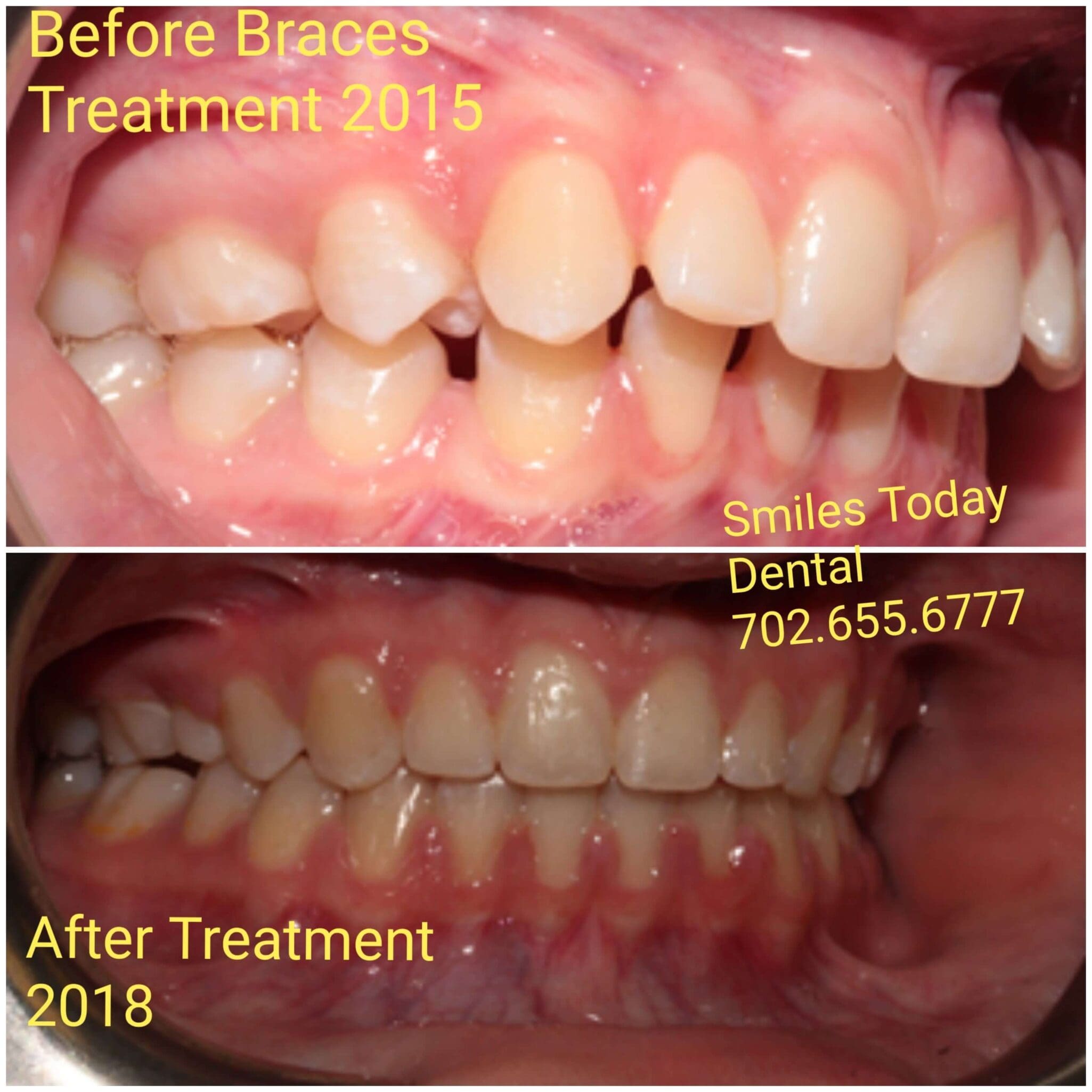 Before And After - Smiles Today Dental